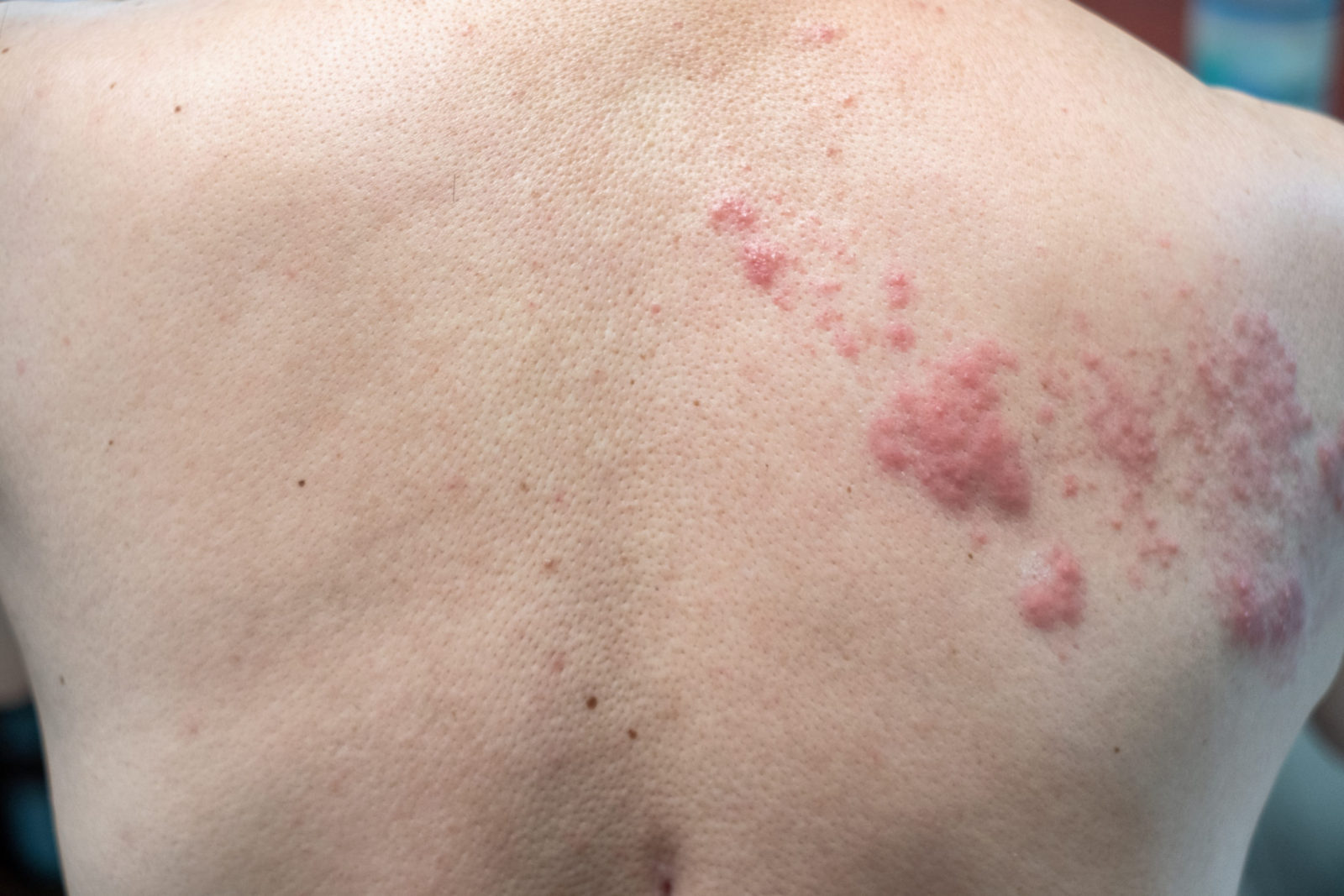 Early Treatment Can Significantly Ease The Pain & Duration Of Shingles ...